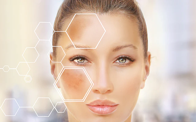 Melasma Face And How To Treat It - Serene Skin Health