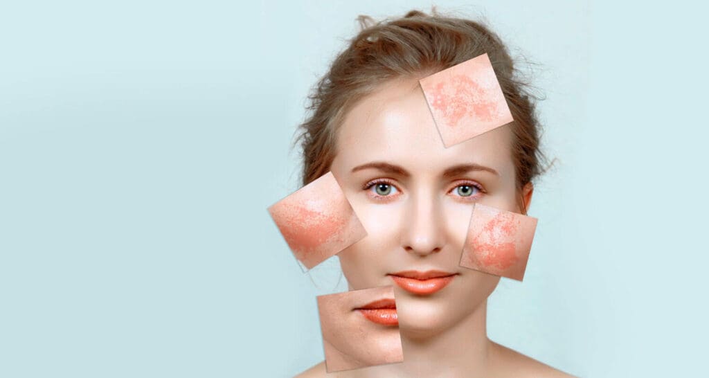 What Is Melasma and Chloasma: Treatment Insights