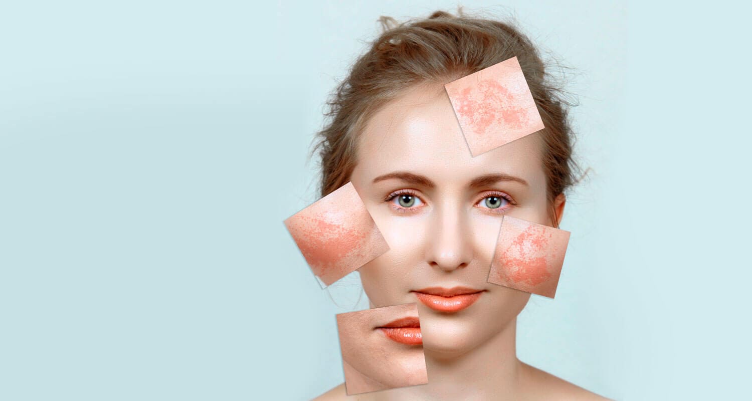 What Is Melasma and Chloasma: Treatment Insights